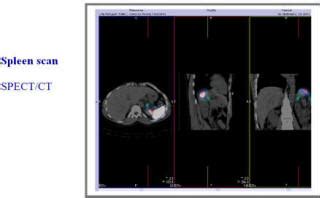 Canterbury District Health Board Splenic Scan