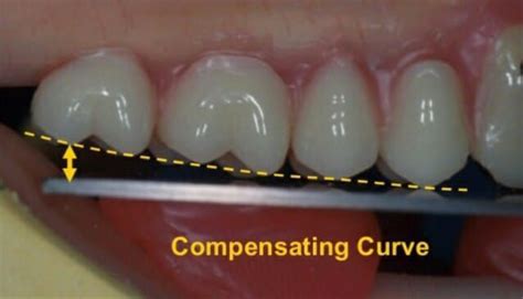 Fundamentals In Tooth Preparation Ppt Video Online Download Artofit