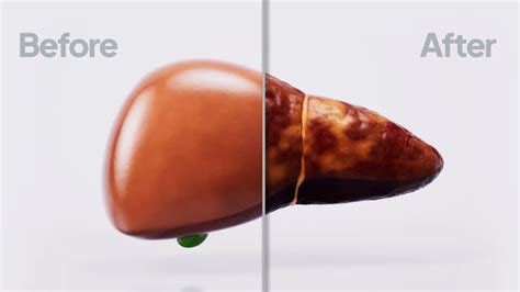 Men Could Be Twice As Likely As Women To Have Injured Liver A Quarter