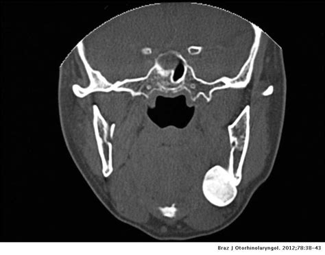 Peripheral Osteoma Of The Maxillofacial Region A Study Of 10 Cases