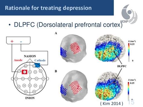 Clinical Application Of Tdcs