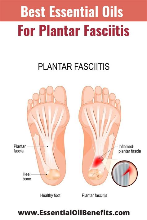 Best 12 Essential Oils For Plantar Fasciitis When Your Feet Start