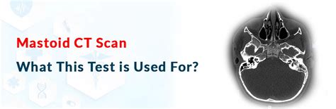 Hu Ct What The Ct Is About Ganesh Diagnostic