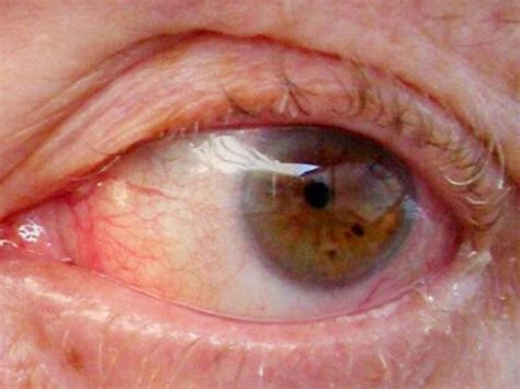 9 Glaucoma Symptoms You Should Not Avoid