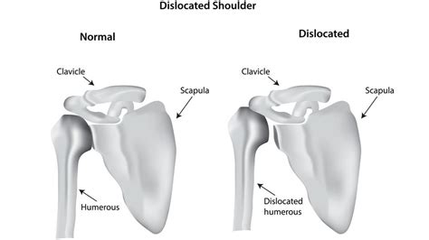Glenohumeral Joint Dislocation