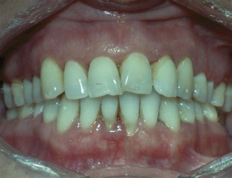 Perio Unit 4 Previous Classification Flashcards Quizlet