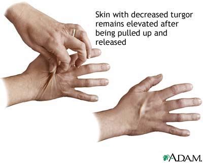 Skin Turgor Medlineplus Medical Encyclopedia