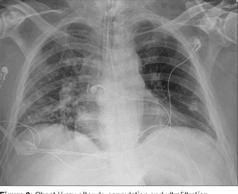 Figure 3 From Venovenous Ecmo For Acute Chronic Heart Failure After