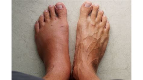 Tanda Tanda Gout Di Kaki Kirstentaroluna