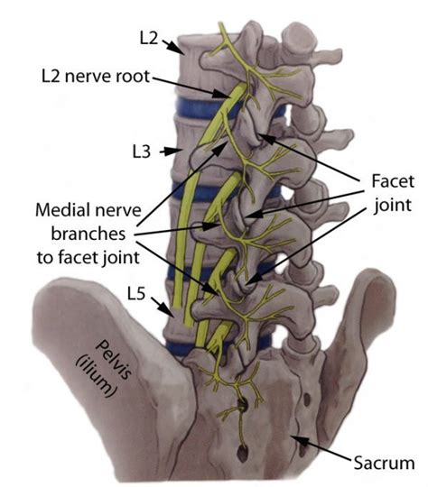 What Is Radiofrequency Ablation Facet Joint At Edward Mcfarlane Blog