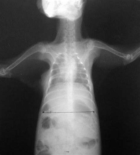 Postoperative 7th Day Chest Radiograph Of A Rabbit Of Control Group