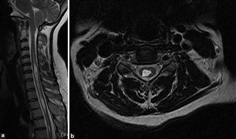Arachnoiditis Its Causes Symptoms Types And Treatment Page 2
