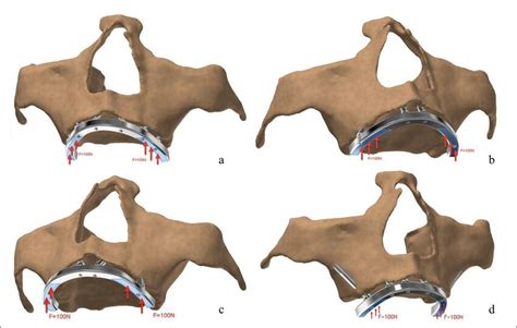 Occlusal Forces On Posterior Region Of Each Group The Total Occlusal