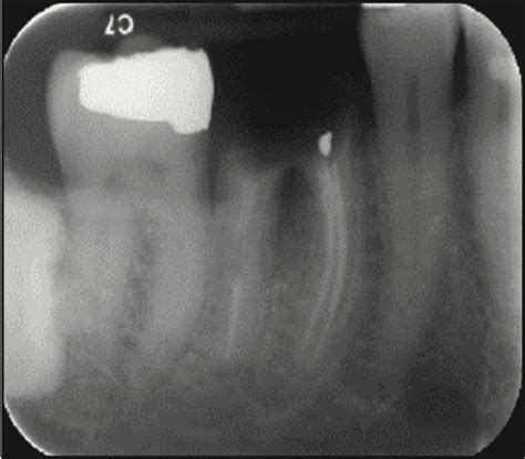 Laser Assisted Socket Grafting A Novel Technique Dentistry Today