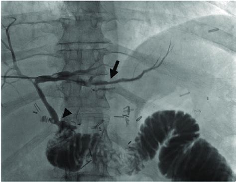 Cholangiogram Obtained Through A Percutaneous Transhepatic Biliary