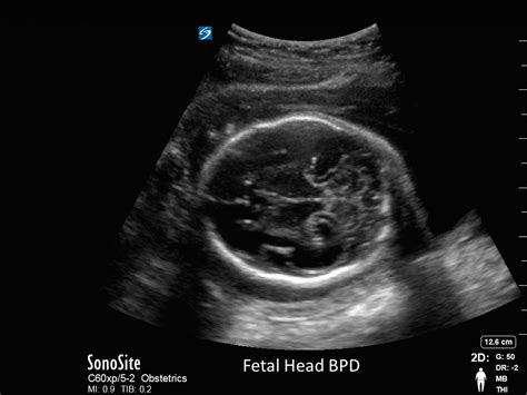 Clinical Images And Videos Fujifilm Sonosite
