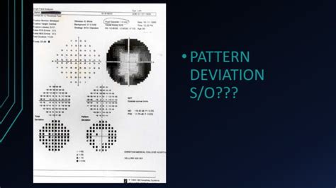 Perimetry Pptx Eye And Vision Conditions Diseases And Conditions