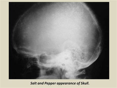 Secondary Hyperparathyroidism Salt And Pepper Appearance At Sandra