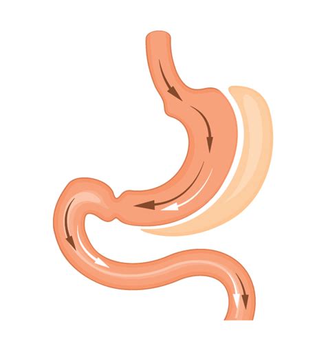The Gastric Sleeve Is Performed By Dr Bruce From Bruce Bariatrics Regularly At Wakemed Hospital