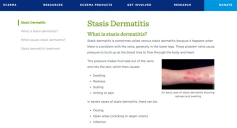 About Stasis Dermatitis Dermatitis Academy