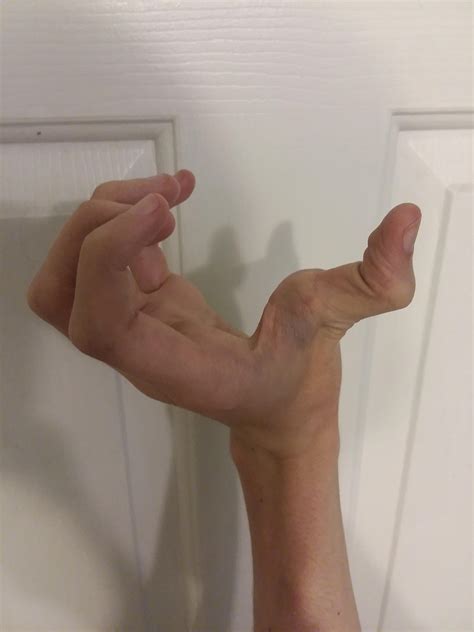 Missing Chromosones Rwestwendover