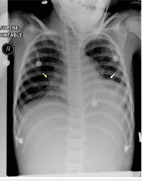 Plain Chest X Ray Anteroposterior View Showing Opacity In The Left Download Scientific