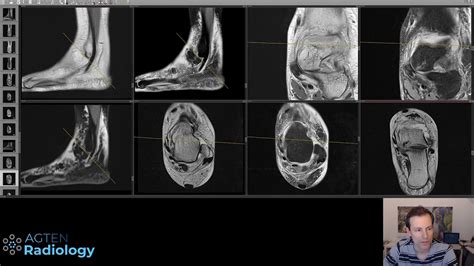 Live Mri Interpretation Ankle Youtube