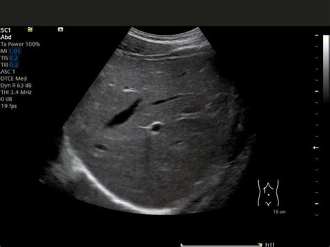 What Your Abdominal Ultrasound Report Means International Ultrasound