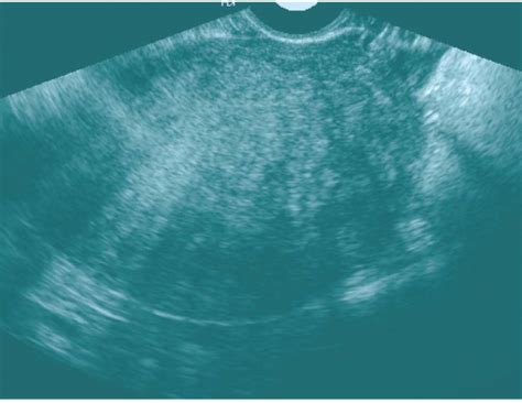 Diseases Of The Uterus Radiology Key