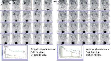 A The Split Function Calculated By Tc 99m Dtpa Renal Scan In