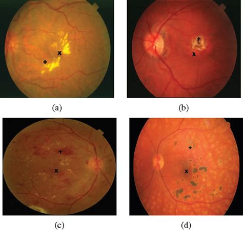 Figure 1 From Detection Of Macula And Fovea For Disease Analysis In