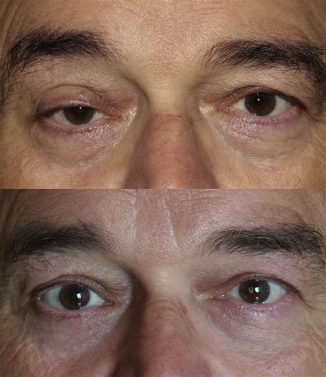 Blepharoptosis Repair External Versus Posterior Approach Surgery Why