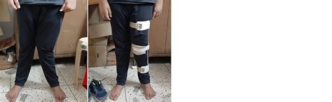 Salo Orthotics Knock Knee And Bow Legs Brace