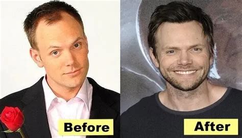 Unveil The Reality Of Joel Mchale Hair Transplant Hair System