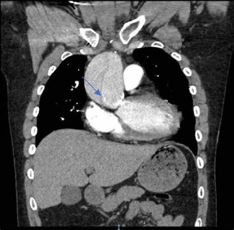 Cta Chest Coronal View Demonstrating Acute Aortic Dissection In Setting