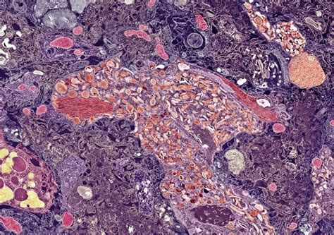How One Mans Rare Alzheimers Mutation Delayed The Onset Of Disease