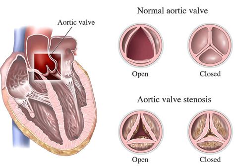 Aortic Stenosis Aortic Valve Disease Types Symptoms And Causes