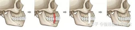 双颌前突（突嘴）矫正 自信显露你的笑颜 知乎