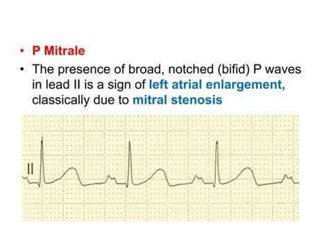 P Wave In Ecgabnormalities Of P Wave In Ecg Pptx Heart And