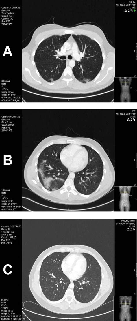 A Ct Scan Following Completion Of Bep Regimen Cumulative Bleomycin Download Scientific Diagram