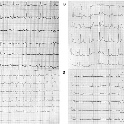 St Segment Evolution A C Initial Electrocardiogram Ecg At The