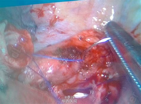 大医院技术更好？ 右上肺鳞癌伴肺不张一例 医联