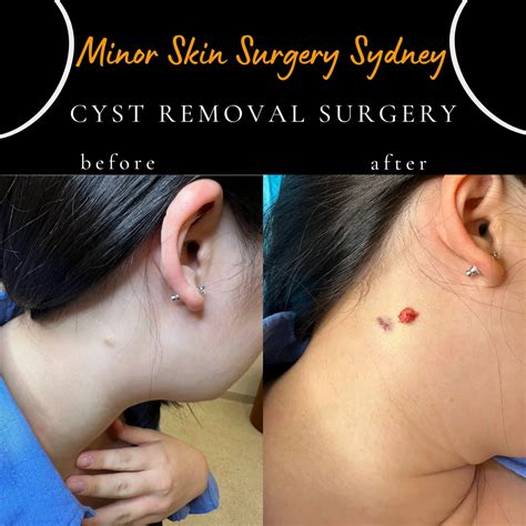 Cyst Surgery Cyst Removal Cyst Treatment Sydney