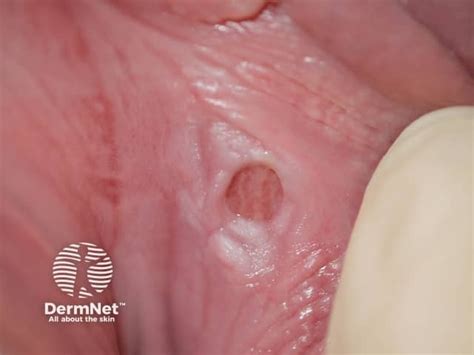 Vulval Ulceration Image