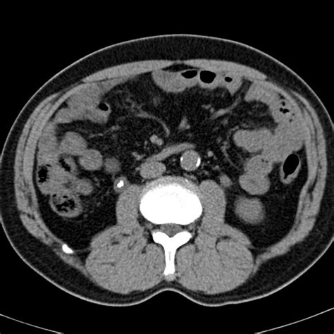 Phlebolith Vs Ureterkonkrement Pacs