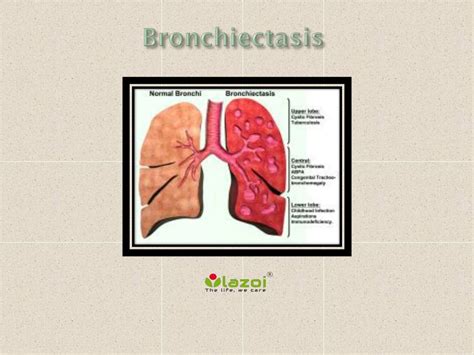 Ppt Bronchiectasis Powerpoint Presentation Free Download Id424755