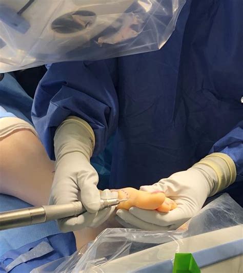 What Is Minimally Invasive Foot And Ankle Surgery