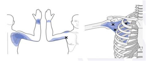 Subscapularis Tendonitis Flashcards Quizlet
