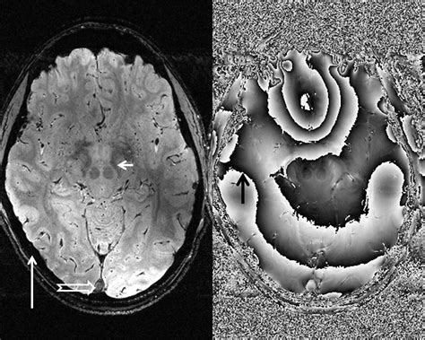 Figure 11 From Harmonic Phase Processing In Magnetic Resonance