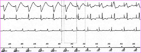 Biventricular Algorithms Crt Programming Biventricular Algorithms Crt Programming